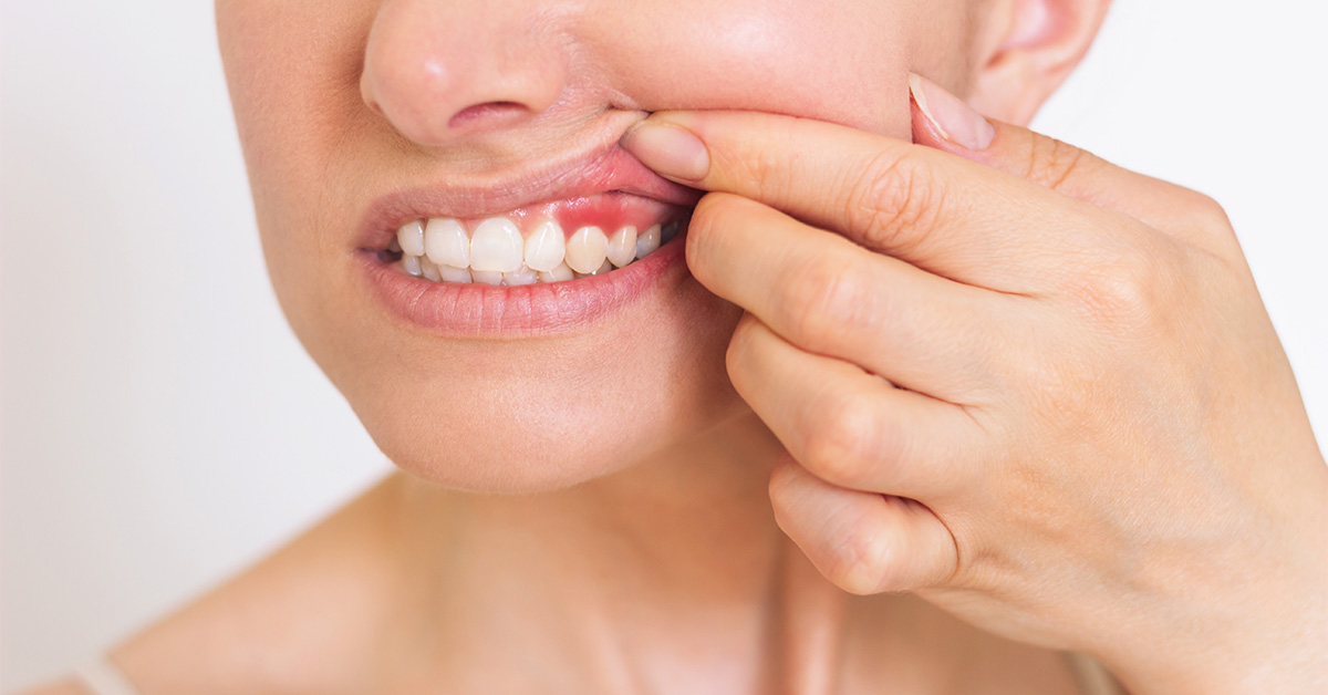 Marco Island Dentists Highlight LANAP Laser Surgery